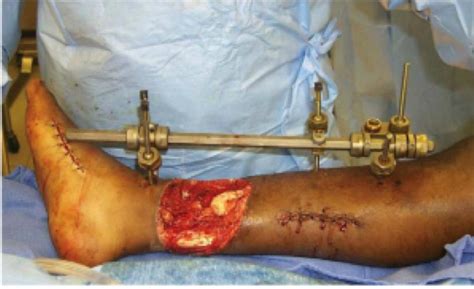 Open Tibia Fracture