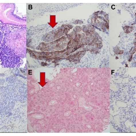 A Gastroesophageal Junction Shows Large Friable Mass On Endoscopy Download Scientific