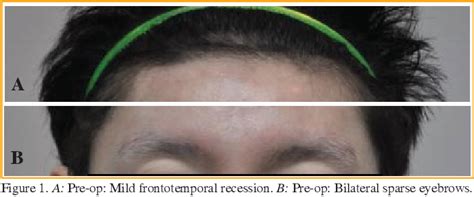 Figure 1 From Folliculitis And Scarring After Eyebrow Transplantation
