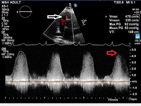 Transthoracic Echocardiogram Vsd Jet Was Identified To Be Around 4 Download Scientific Diagram