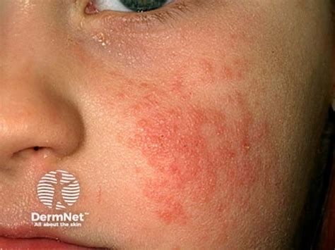 Infantile Papular Acrodermatitis Gianotti Crosti Images