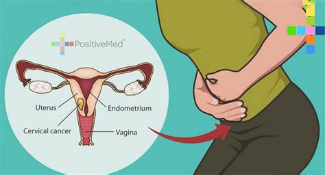 10 начальных признаков рака шейки матки которые нельзя игнорировать