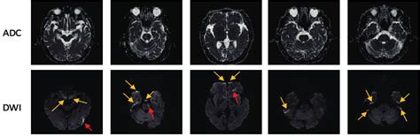 Challenge Examples In Acute Ischemic Stroke Ais Segmentation The Download Scientific Diagram