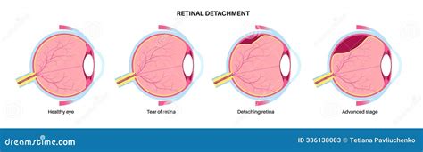 Retinal Detachment Cross Section Of The Eye Vector Illustration 331280848