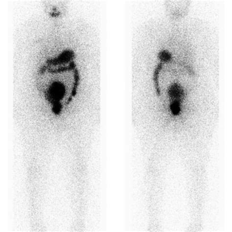 Tc 99m Pertechnetate Thyroid Scan Shows A “hot” Nodule In The Right Download Scientific Diagram