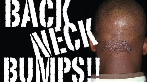 Unbelievable Tips About How To Get Rid Of Bumps On Back Head Bushnerve