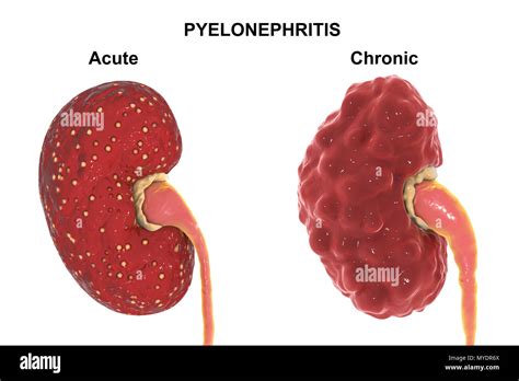 Comparison Of Gross Anatomy Of Acute And Chronic Pyelonephritis Illustration There Are Small