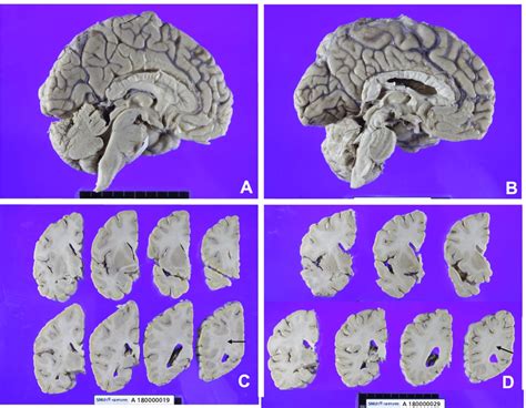 A D Gross Histology Of Both Cases Revealed Mild Global Atrophy The