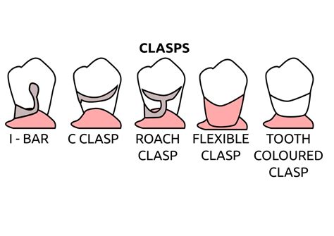 Clasp Design For Removable Partial Denture At Hamish Geake Blog