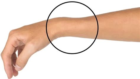 Colles Fracture Symptoms Treatment And Recovery Explained