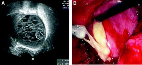 Pasteurella Multocida Human Infection