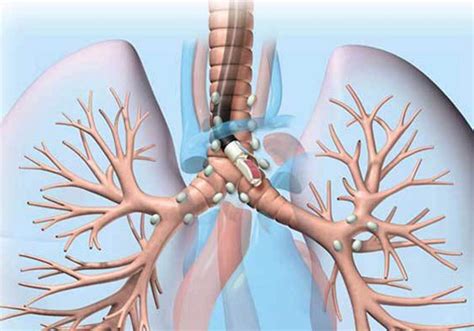 Endobronchial Ultrasound Ebus Sleep And Lung Care