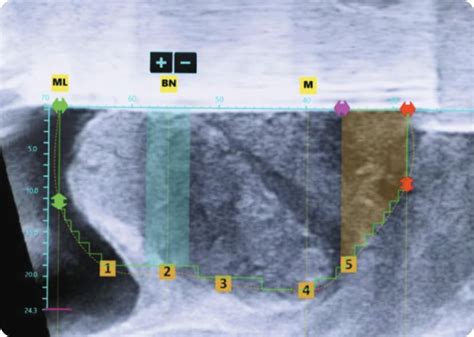 Aquabeam Robotic System For Bph Treatment Procept Biorobotics