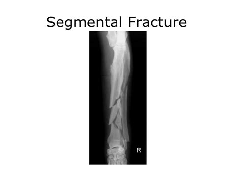 Ppt Orthopedics And Fractures Powerpoint Presentation Free Download