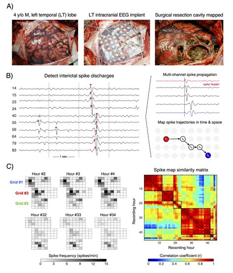 fluctuating spike patterns in long term intracranial recordings among