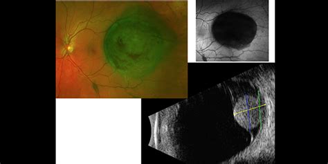 New Scoring System Helps Differentiate Between Ocular Melanoma And