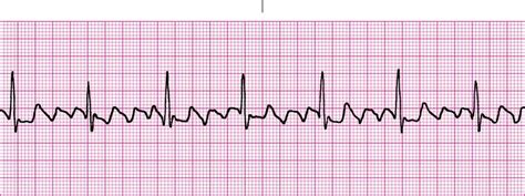 Atrial Flutter The Student Physiologist