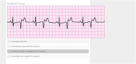 Solved Sinus Rhythm With Pacsatrial Fibrillation Afib