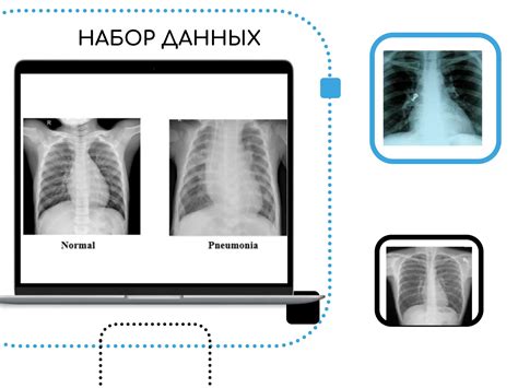 Pneumonia Classification Program Development Using Neural Networks
