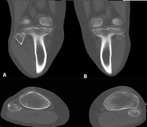 Proximal Tibiofibular Joint