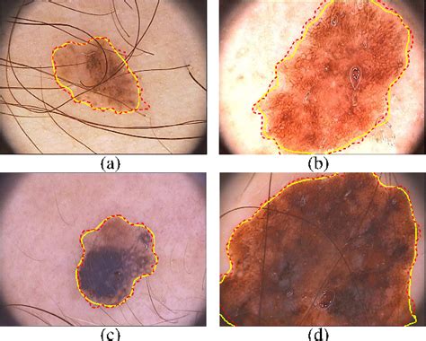 Figure 6 From Automatic Skin Lesion Segmentation Using Deep Fully