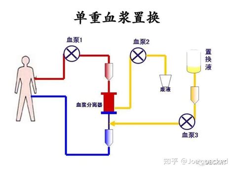 血浆置换 知乎