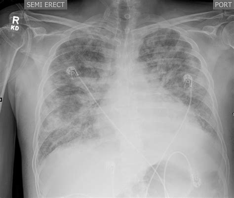 284lu Ards Adult Respiratory Distress Syndrome The Common Vein