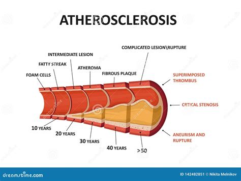 Atherosclerosis Stock Illustrations 1810 Atherosclerosis Stock