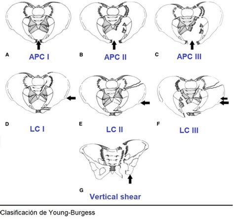 Fracturas De Pelvis