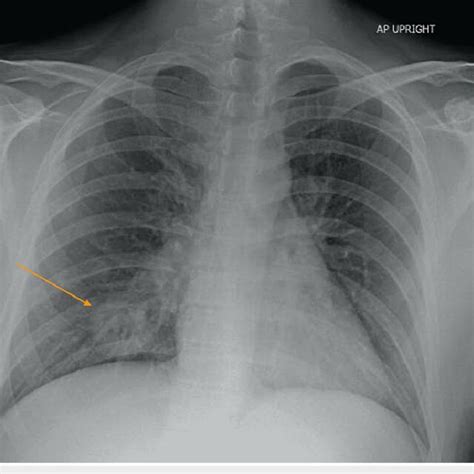Chest X Ray Showing The Presence Of A Mass Like Opacity In The Medial