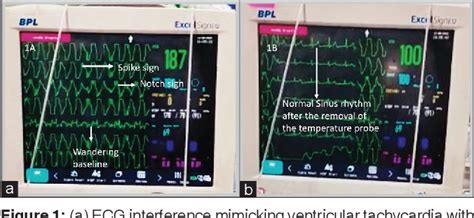 Figure 1 From Ecg Interference Due To Nasopharyngeal Temperature Probe
