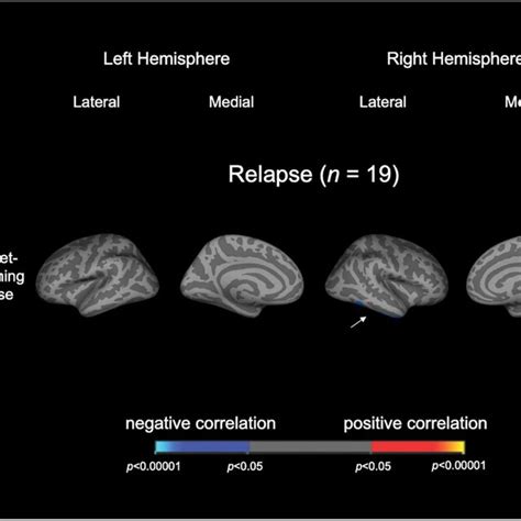 Cortical Statistical Maps Displaying The Significant Correlation Of