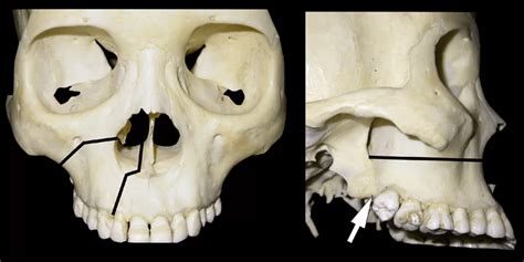Infrastructure Maxillectomy Care Head And Neck Cancer Surgeon
