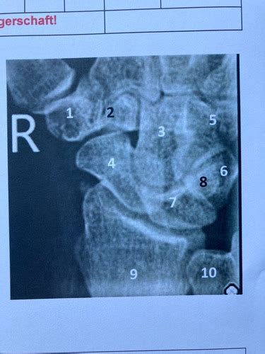Os Scaphoideum 4 Schräg Flashcards Quizlet