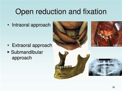 Ppt Comprehensive Overview Of Mandibular Fractures Anatomical
