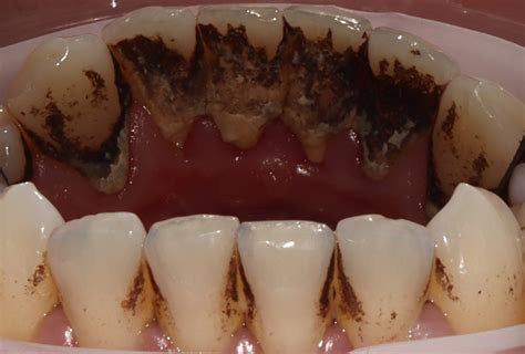 Какво представлява процедурата почистване на зъбен камък Дентална клиника Identity гр Варна