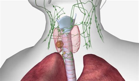 Lymph Node Dissection MedWise Hospitals