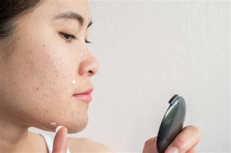 How To Hide Pimples Without Makeup Simple Steps Body Design Style