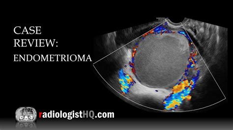 Endometrioma Ultrasound