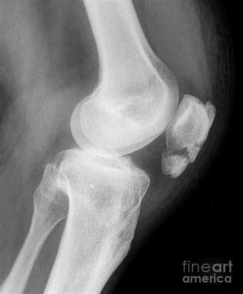 Broken Knee Cap 4 By Science Photo Library