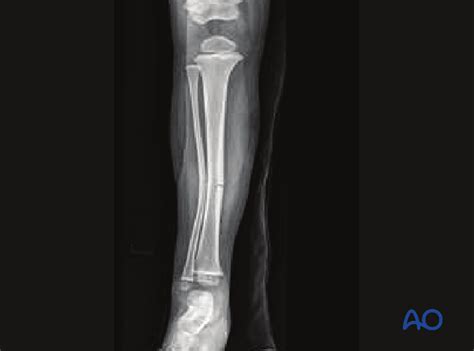 Greenstick Fracture Of The Tibia
