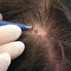 Scalp Biopsy The London Skin And Hair Clinic