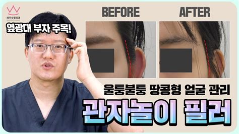 옆광대부자 주목 땅콩형얼굴 주목 관자놀이필러로 해결 Youtube