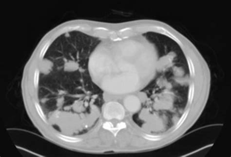 Positive Positron Emission Tomography Computed Tomography Scan And Multiple Pulmonary Nodules