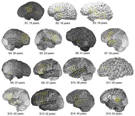 Electrode Locations For Research Participants Intracranial Download Scientific Diagram