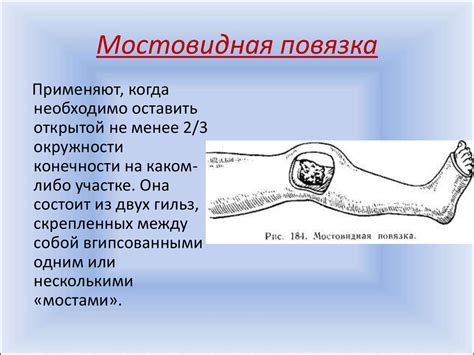 Гипс. Основные виды гипсовых повязок - презентация онлайн
