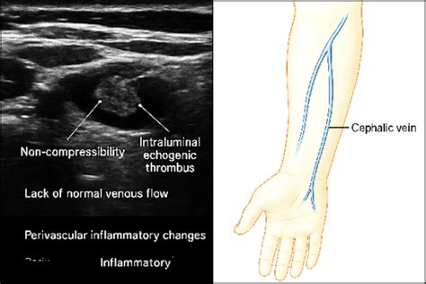 Superficial Thrombophlebitis Of The Cephalic Vein A 52 Year Old Woman