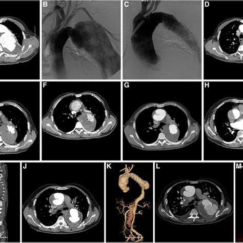 A Three Dimensional 3d Reconstruction Of Preoperative Surgery Cta Download Scientific