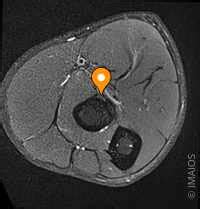 Bicipitoradial Bursa E Anatomy Imaios