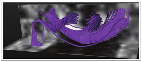 Tractography Results For D2 In The Crossing Regions A A Sketch
